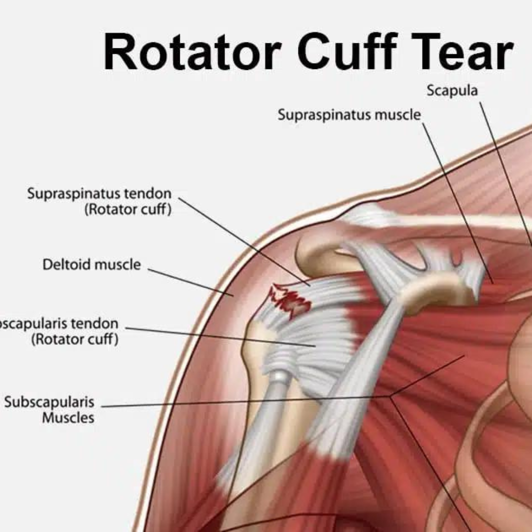 Physical Therapy Approaches to Rotator Cuff Tears